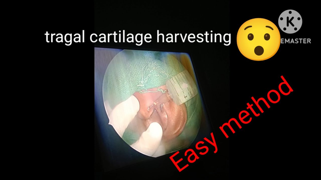 Tragal cartilage graft | harvesting of tragal cartilage | how to take ...