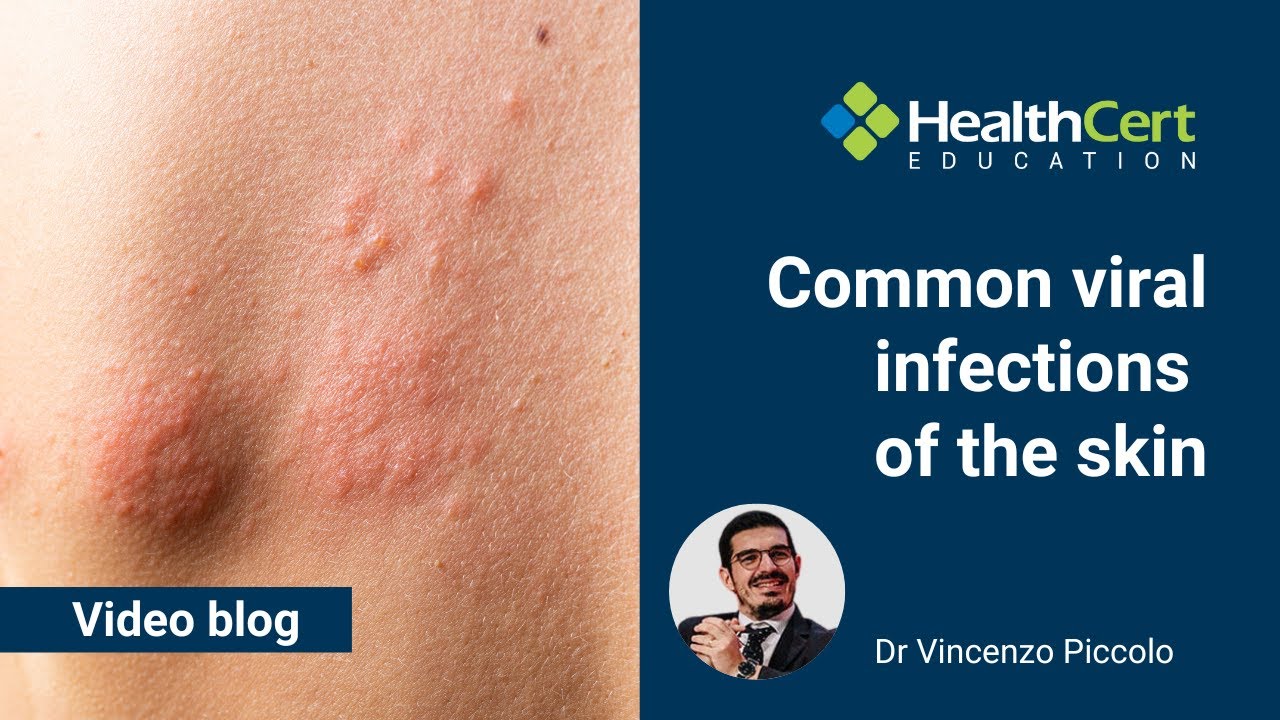 Common viral infections of the skin | Dr Vincenzo Piccolo - YouTube