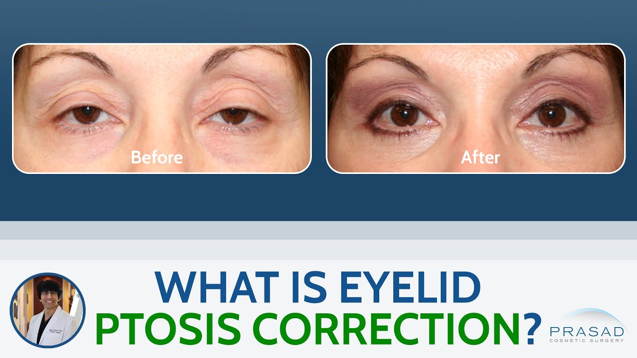 What is Eyelid Ptosis Correction? - YouTube