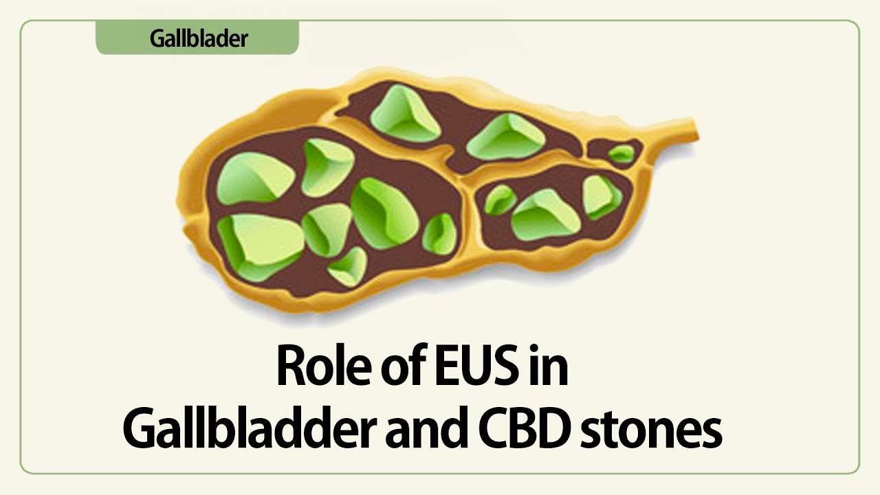 Linear EUS: Role of EUS in Gallbladder and CBD stones - YouTube