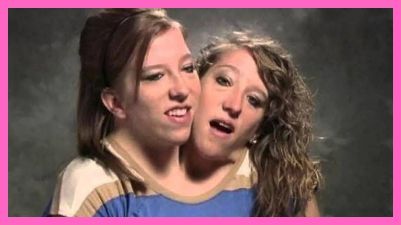 Top 10 Interesting Stories Of Conjoined Twins - YouTube