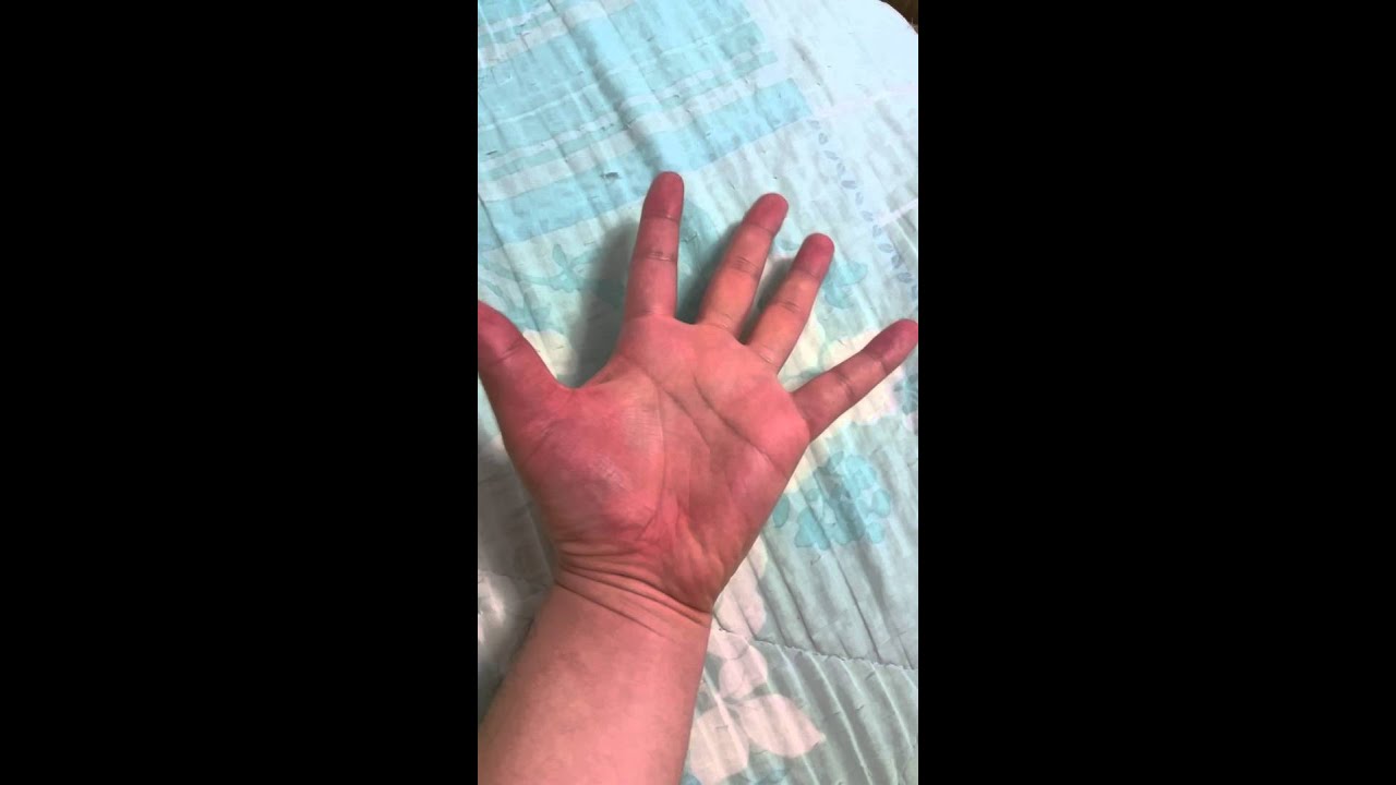 hand ROM exercise - YouTube