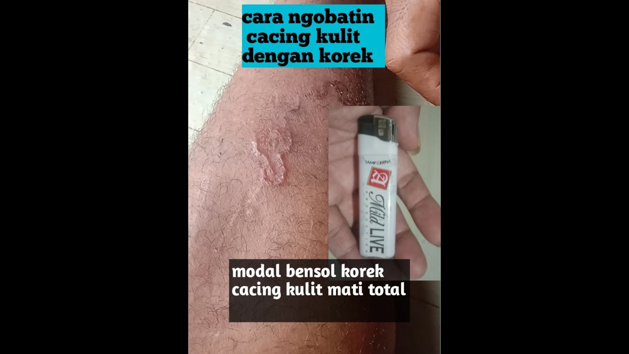 simpel dengan bensol korek cacing kulit hilang/sembuh - YouTube