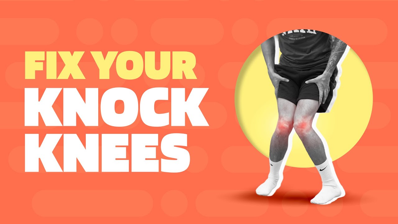 How To Fix Knock Knees (Exercises To Correct Knee Valgus) - YouTube