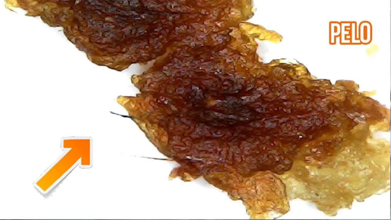 Descubre Como es la Cerilla o Cerumen de Nuestros Oidos Desde el ...