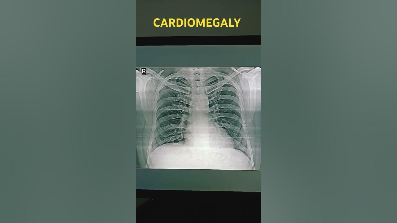 Xray chest pa Cardiomegaly enlarge bronchitis - YouTube