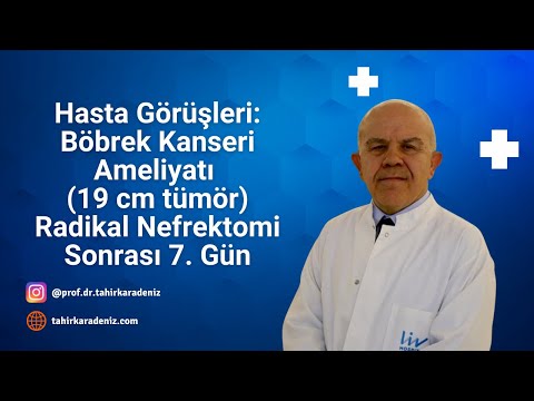 Böbrek Kanseri Ameliyatı (19 cm tümör) Radikal Nefrektomi Sonrası 7. Günde hastamızın görüşleri
