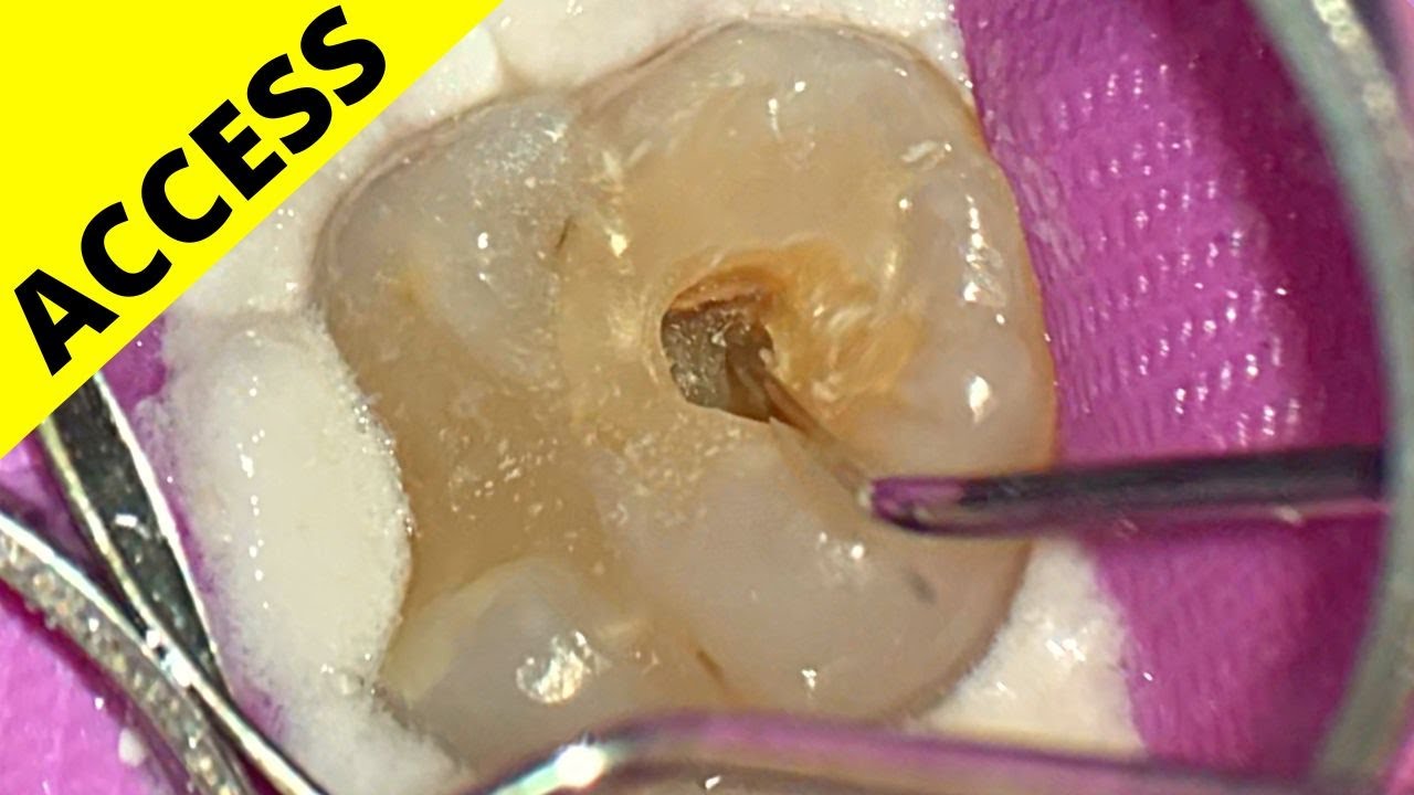 MAX MOLAR ACCESS (Ep.1 of Whole Case) - YouTube