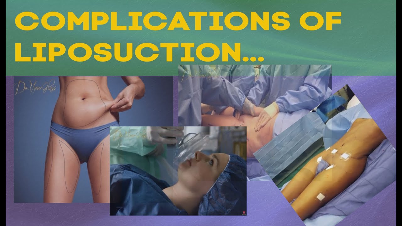 Liposuction Complications