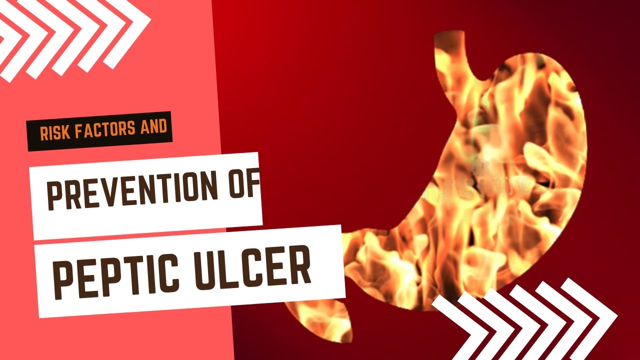 Risk factors, prevention and treatment of peptic ulcer - YouTube