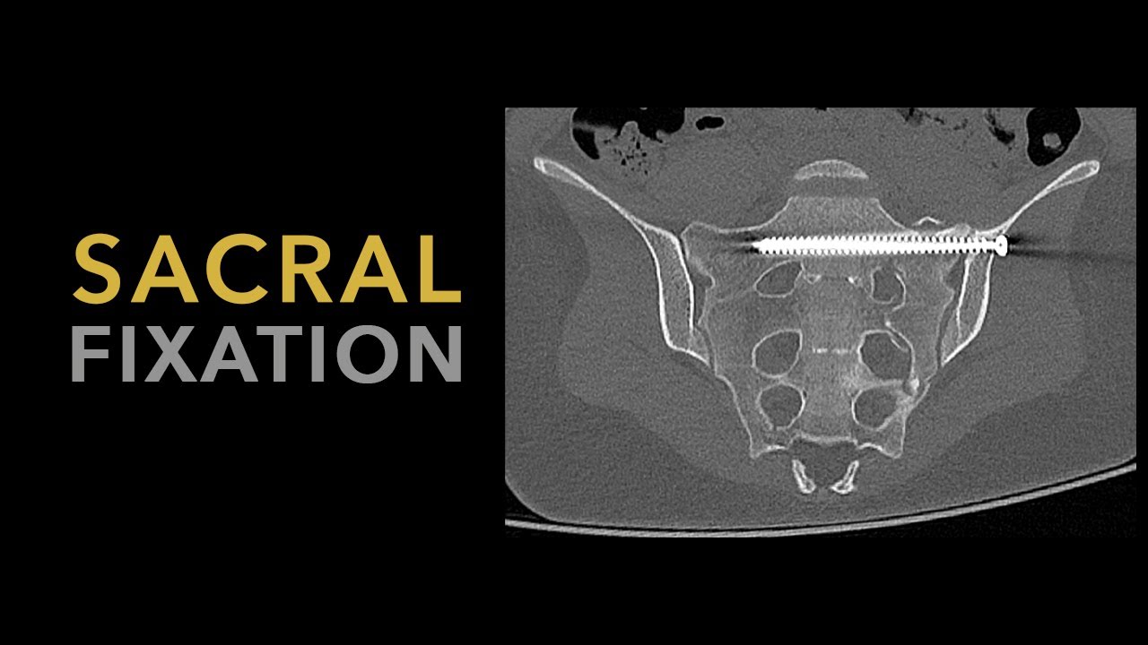 Sacral fixation - YouTube
