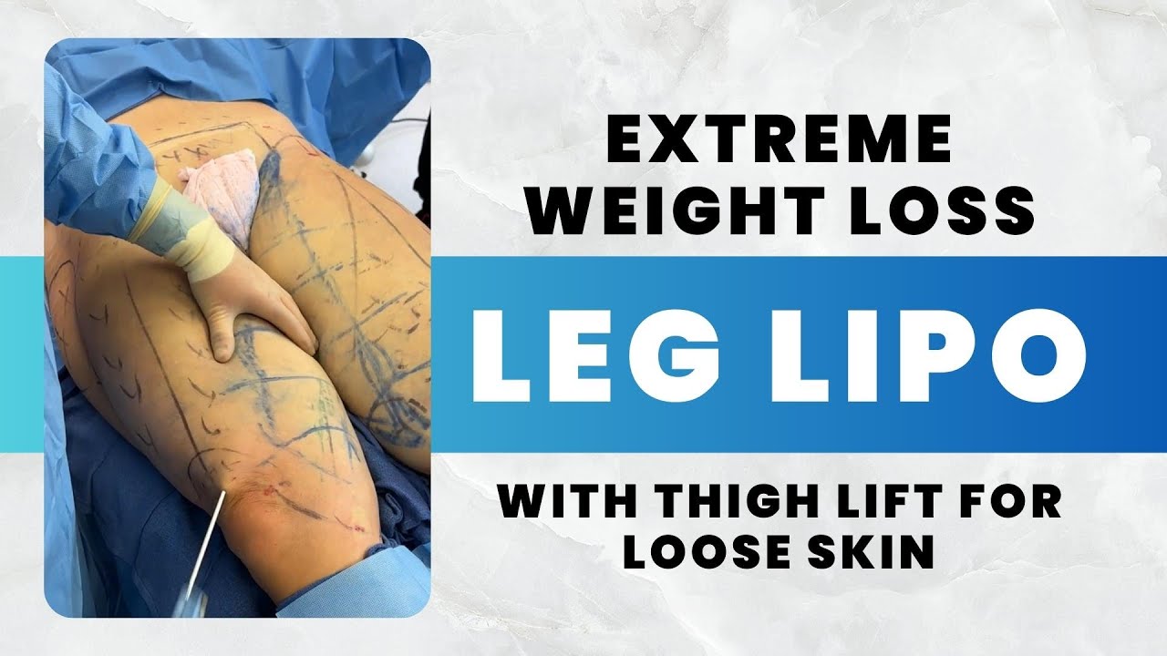 SNAPCHAT LIVE | EXTREME WEIGHT LOSS LEG LIPO WITH THIGH LIFT FOR LOOSE ...