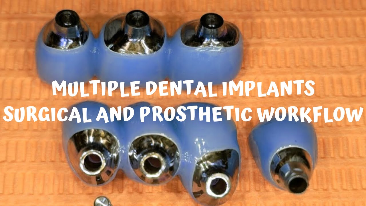 Multiple Dental Implant Restorations - YouTube