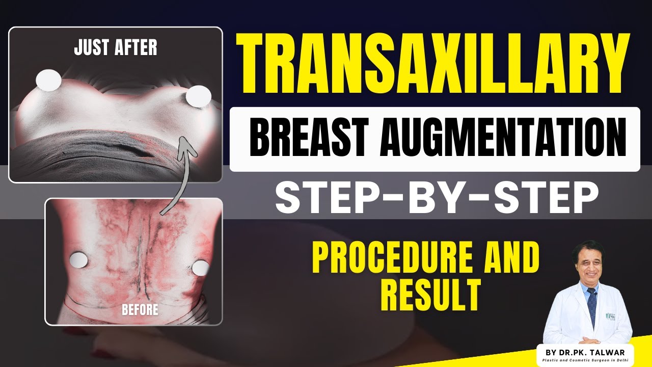 Transaxillary Breast Augmentation Step by Step | बगल से ब्रेस्ट ...
