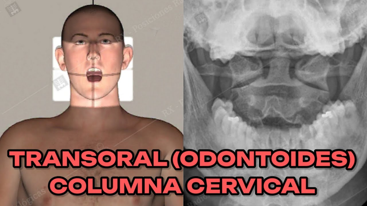 RADIOGRAFÍA TRANSORAL DE COLUMNA CERVICAL (MANUAL DE BOLSILLO) #25 ...