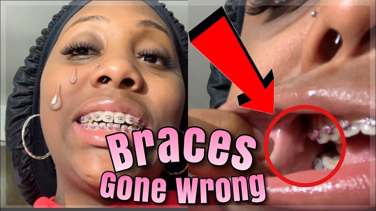 BRACES GONE WRONG!!!! | 2 WEEKS UPDATE ON MY BRACES 😬 💔 - YouTube