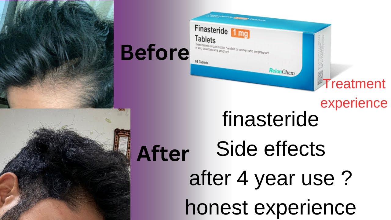 Finasteride side effects after 4 years use and results .EXPERIENCE ...