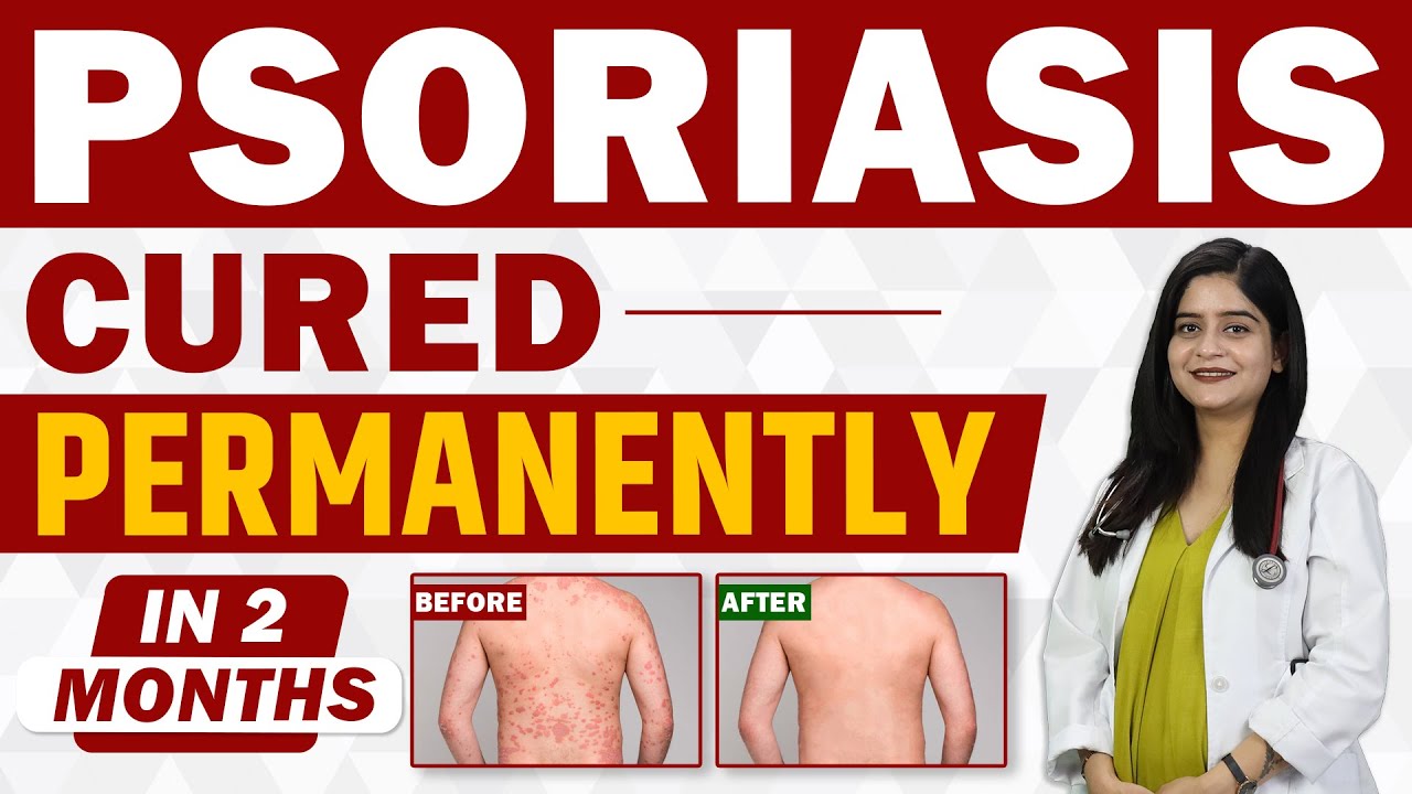 Psoriasis Cured Permanently in 2 Months | Psoriasis Treatment | Dr ...