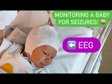 Monitoring a Baby for Seizures on EEG - YouTube