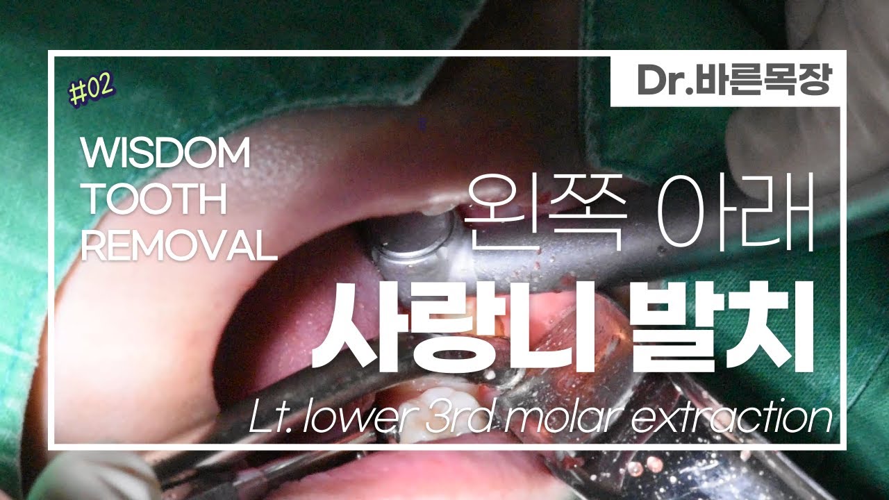 Wisdom tooth removal/사랑니발치/Pulling Wisdom Tooth - YouTube