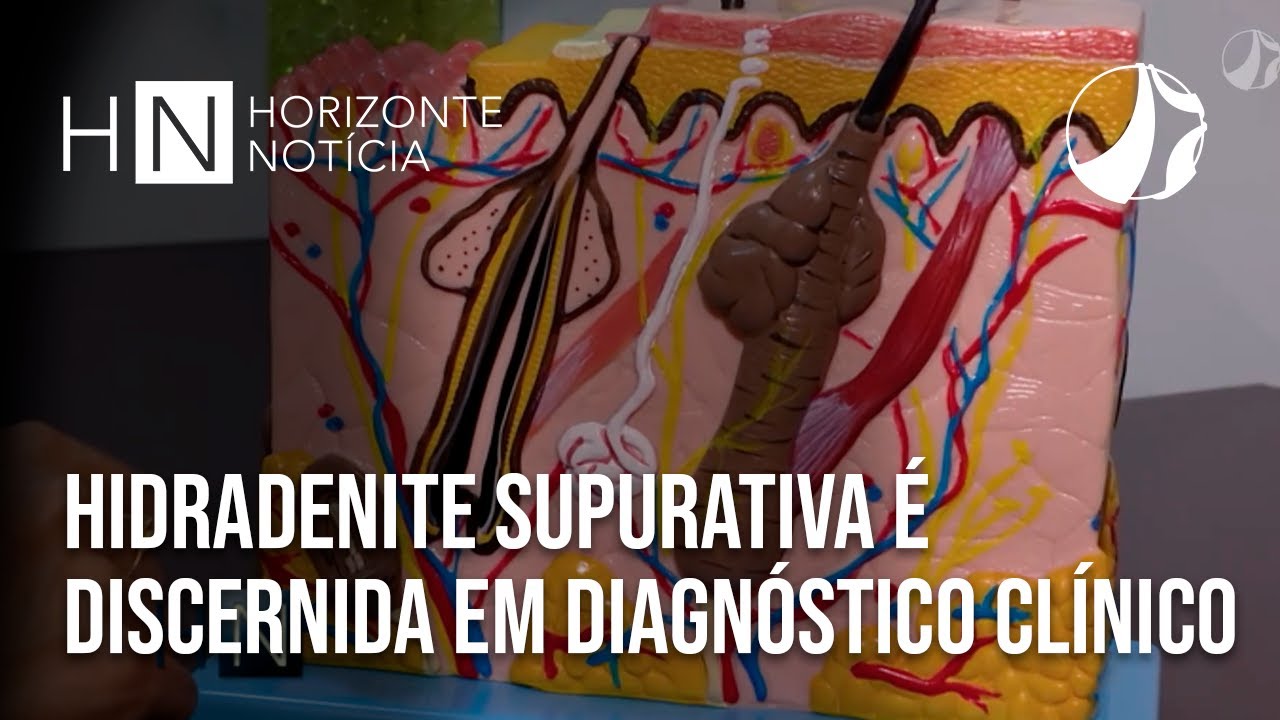 Hidradenite supurativa é discernida em diagnóstico clínico | Horizonte ...