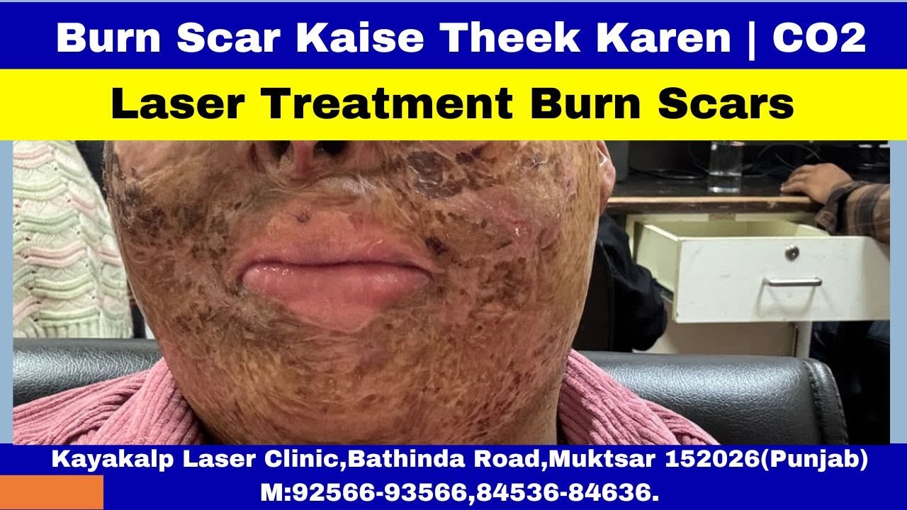 Burn Scar Kaise Theek Karen | CO2 Laser Treatment Burn Scars - YouTube