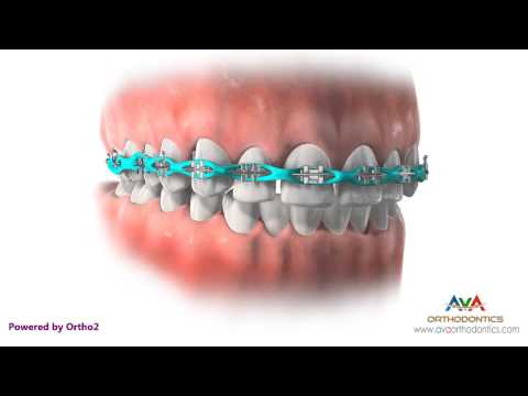 How To Close Space In Orthodontic