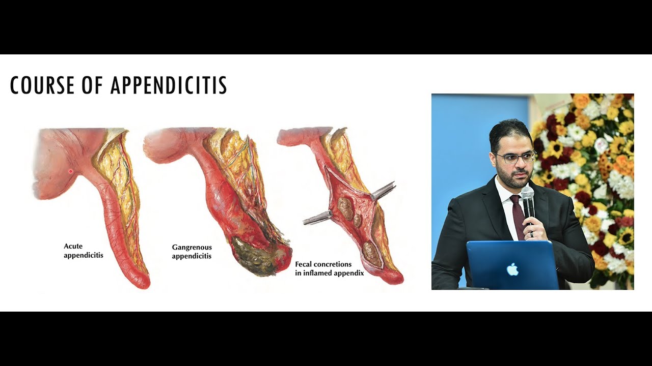 Acute appendicitis lecture Diagnosis and management arabic - YouTube