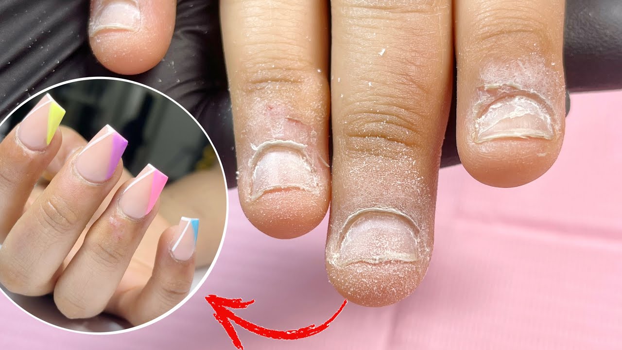 UÑAS MORDIDAS | Trabajando en Uñas con Onicofagia/ Reconstrucción de ...