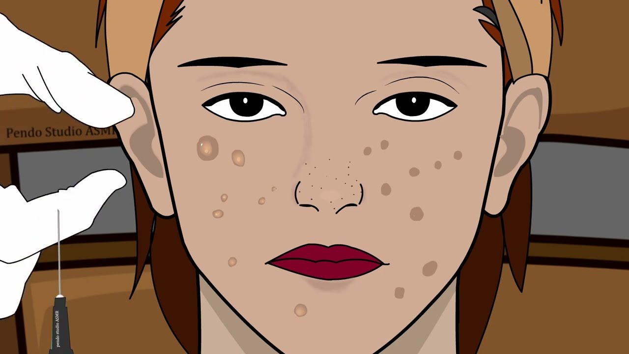 ASMR Pimple Popping SPA! ASMR 핌플팝핑스파! Pimple/Acne removal animation ...