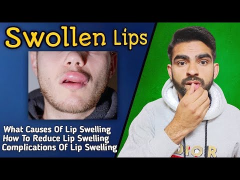 Swollen Lips in urdu/hindi || How to get rid of swollen lips || Swollen lips treatment