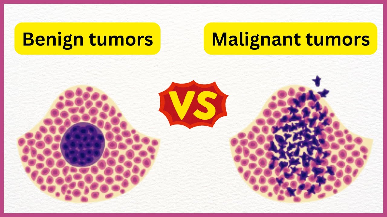 Benign vs Malignant Tumors | Key Differences, Growth, and Spread ...