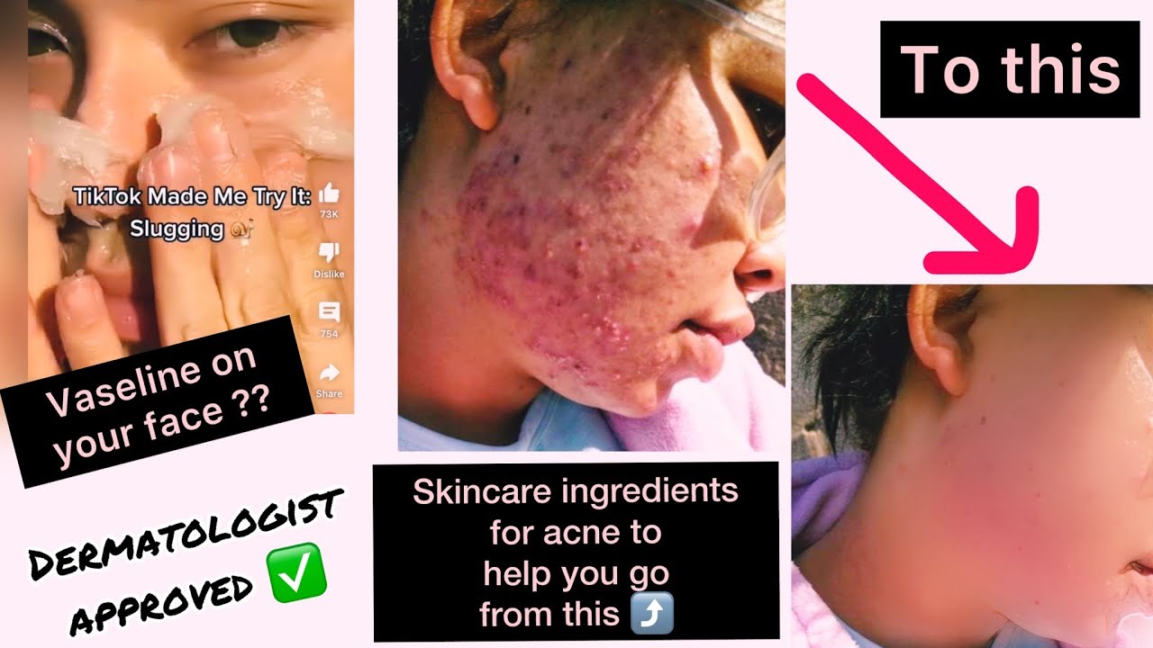 How to clear acne FAST /say bye to rough face| best moisturizer for ...
