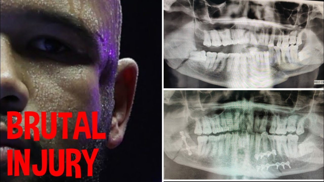 Frazer Clarke's BRUTAL JAW INJURY! MY experience of a BROKEN JAW/EYE ...