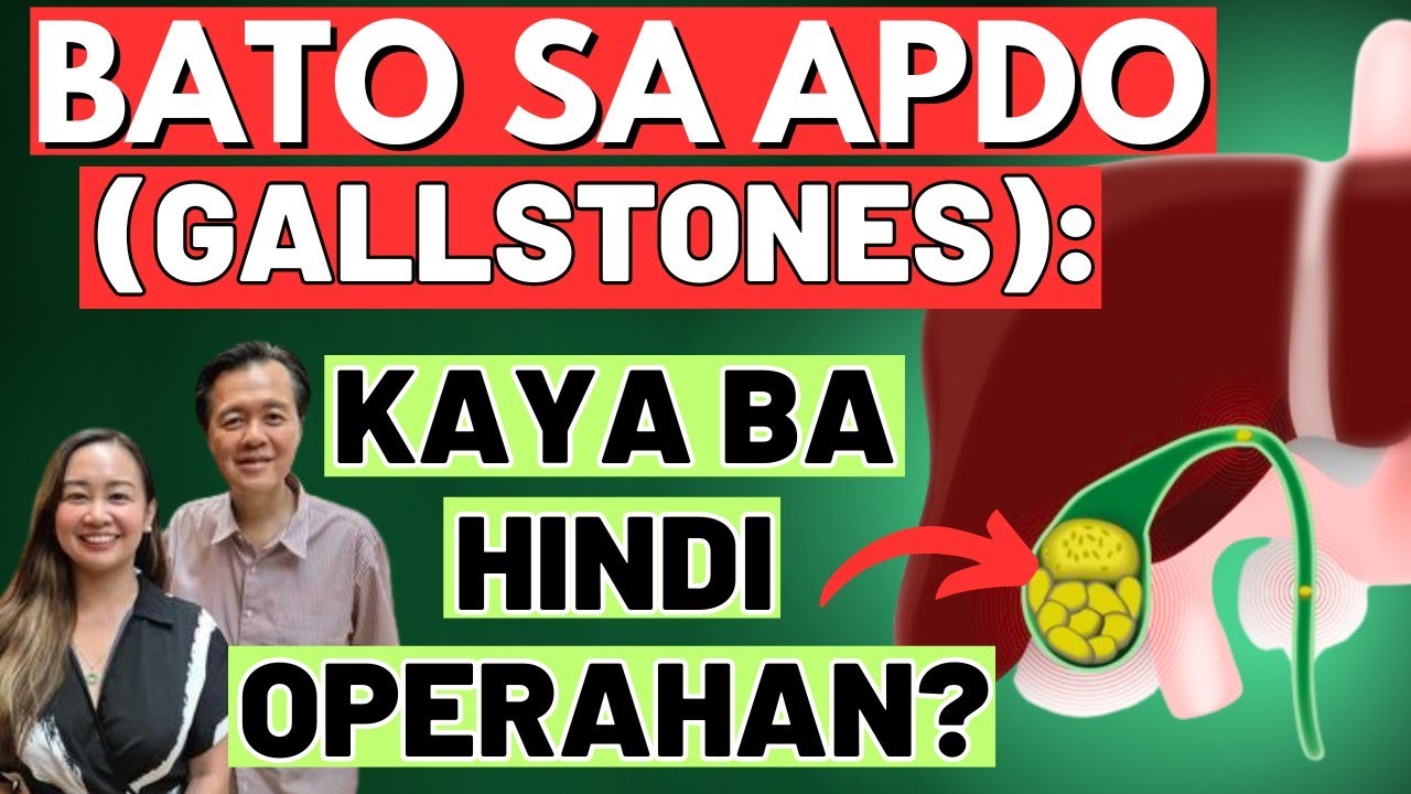 Bato sa Apdo (Gallstones): Kaya Ba Hindi Operahan? - By Doc Willie Ong ...