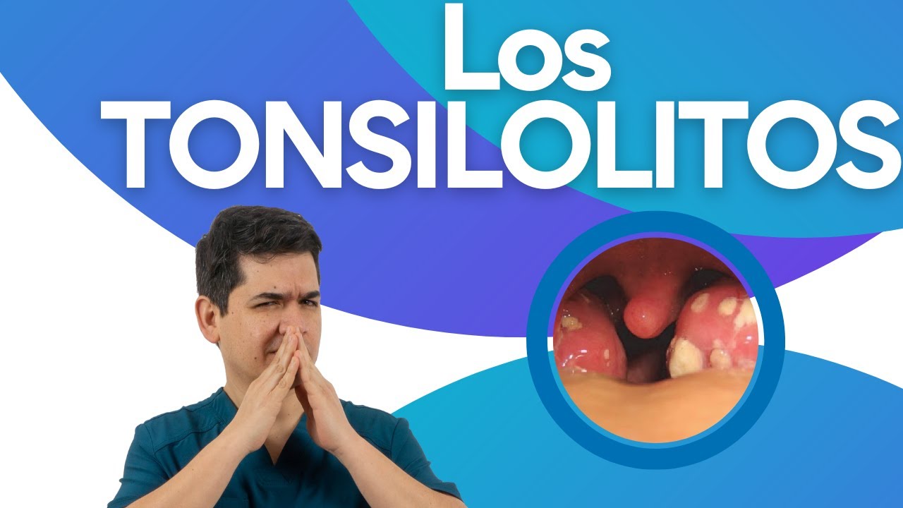 Episodio 44. Los TONSILOLITOS: Bolitas BLANCAS que causan MAL ALIENTO 😵 ...