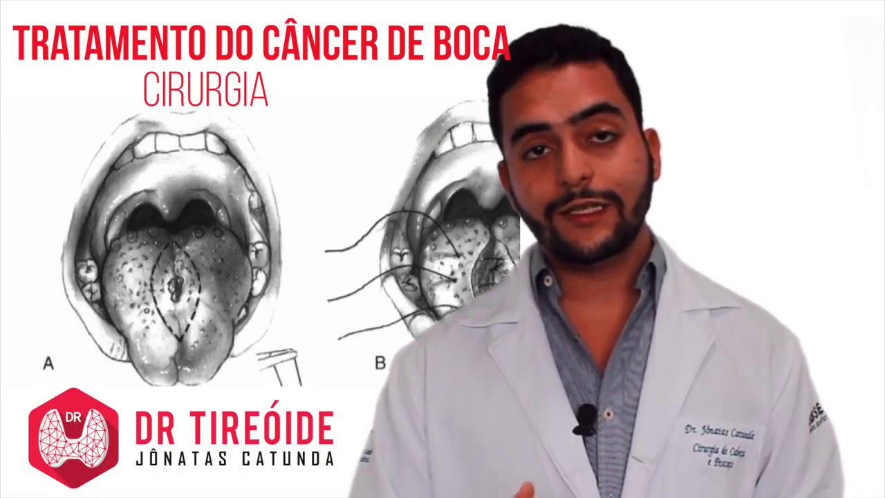 Câncer de boca Sintomas, Diagnóstico, Tratamento e Prognóstico Dr ...