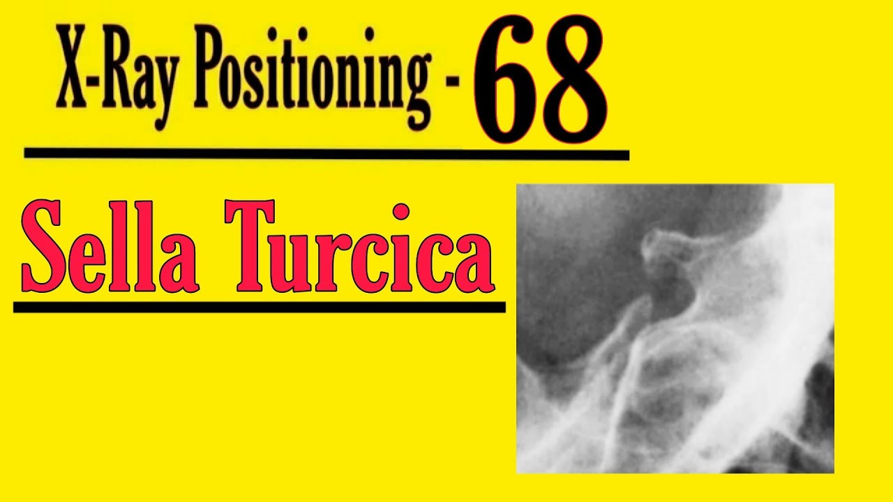 Sella Turcica X Ray
