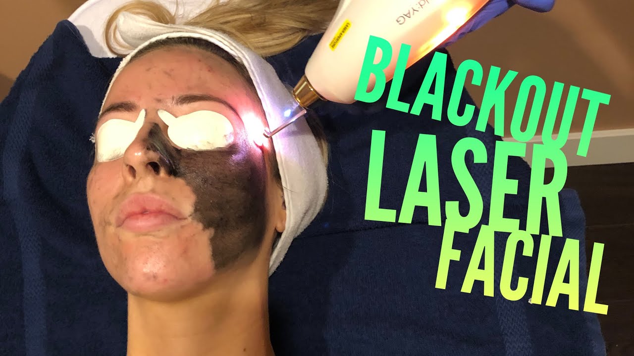 I GOT A BLACK OUT LASER FACIAL! | VLOG 13 - YouTube