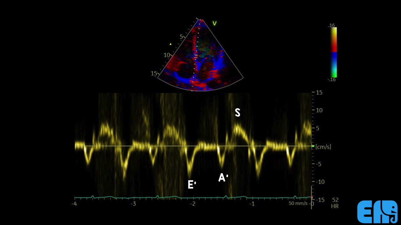 Eco en Emergencias Capitulo 5 (Doppler tisular) - YouTube