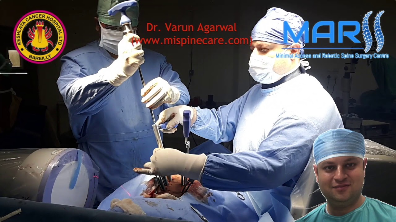 JAYON MIS screw technique step by step - YouTube