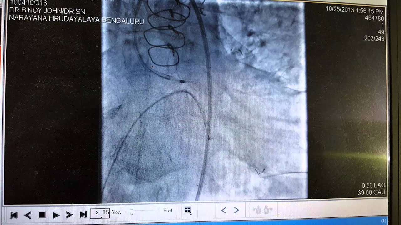 ROTABLATION-ANGIOPLASTY MORE!!! DR BINOY JOHN (ROTABLATION 2013 ...