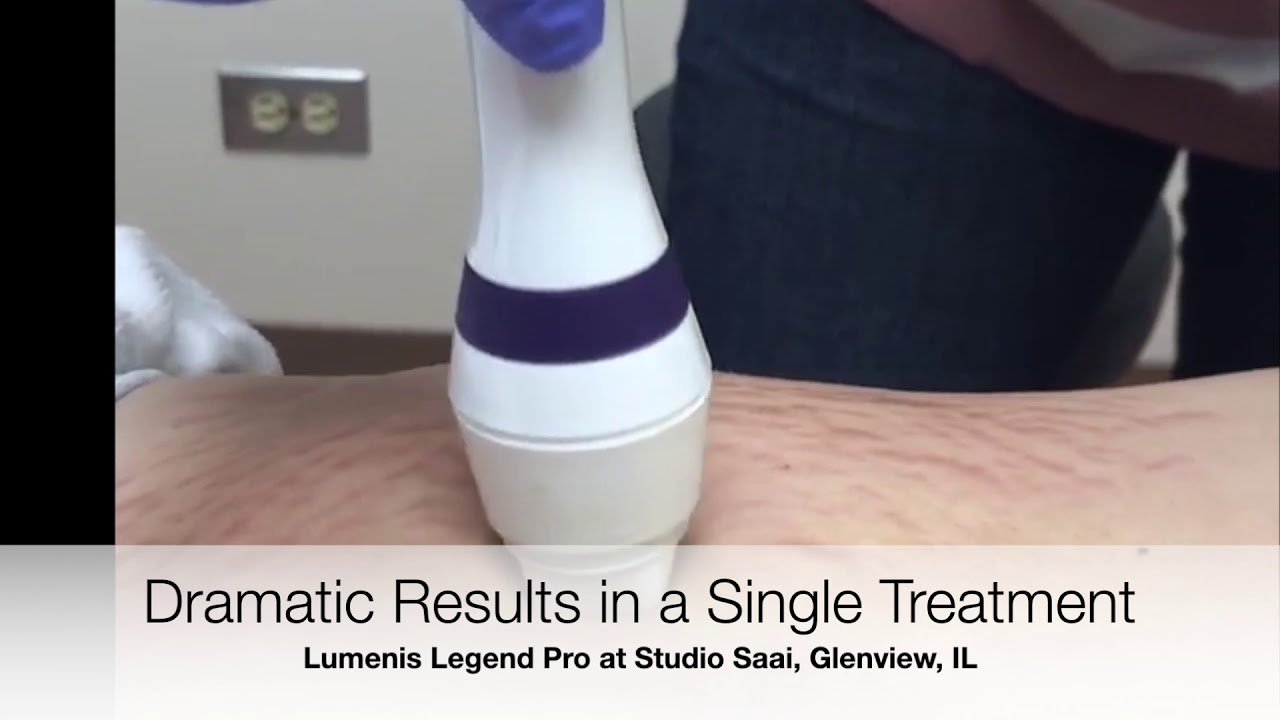 Radio Frequency Microneedling with Lumenis Legend Pro - YouTube