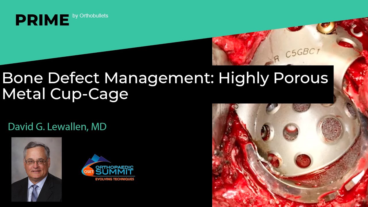 Bone Defect Management Highly Porous Metal Cup Cage - David G. Lewallen ...