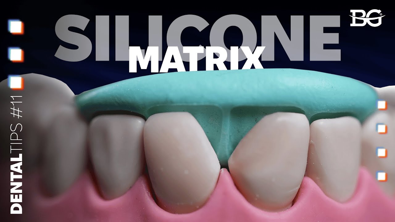 Silicone index technique for tooth restorations - YouTube