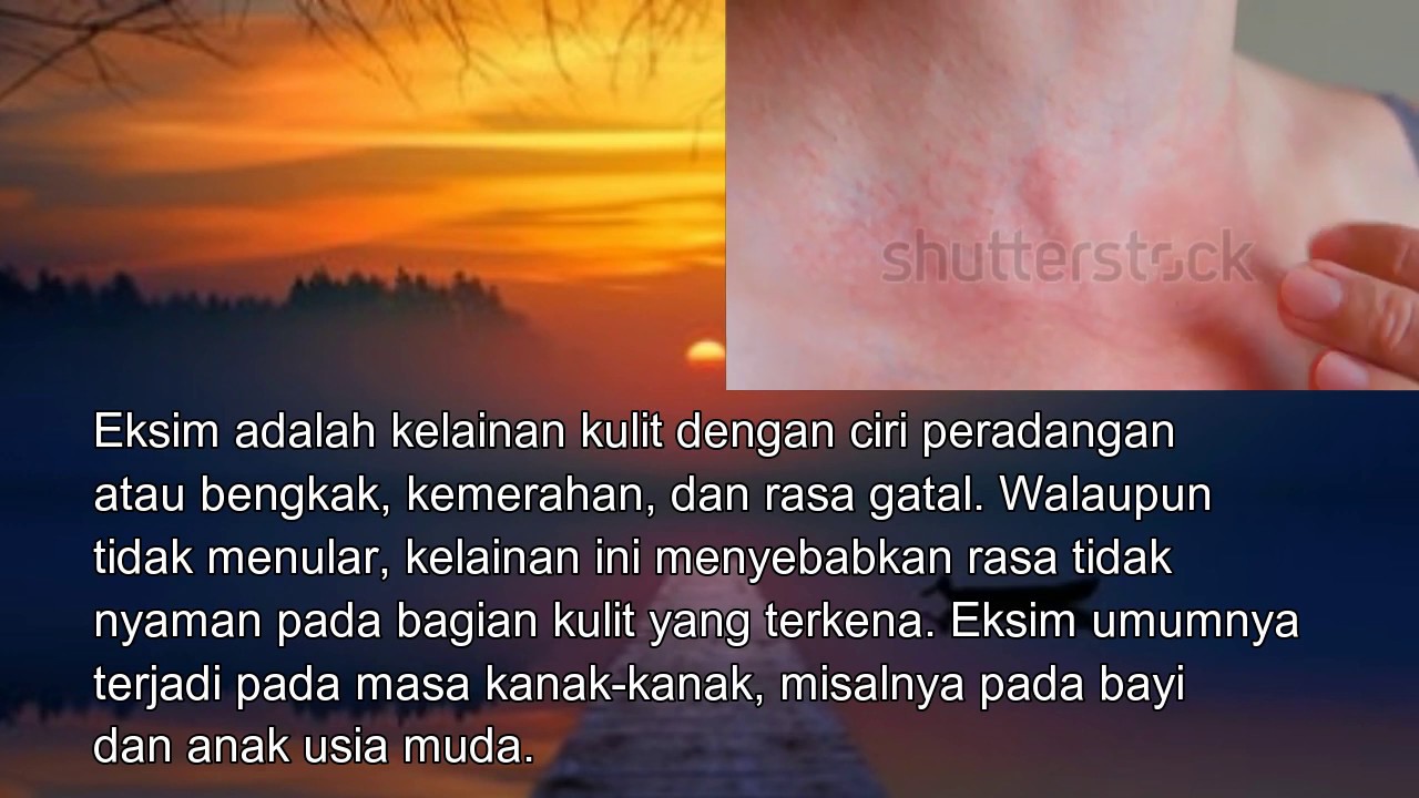 Obat apa yang cepat menyambuhkan eksim - YouTube