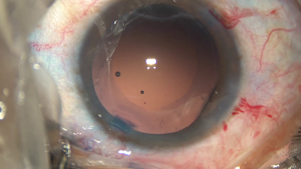 Phaco plus Multifocal IOL implantation : Pradip Mohanta, 12/4/2019 ...