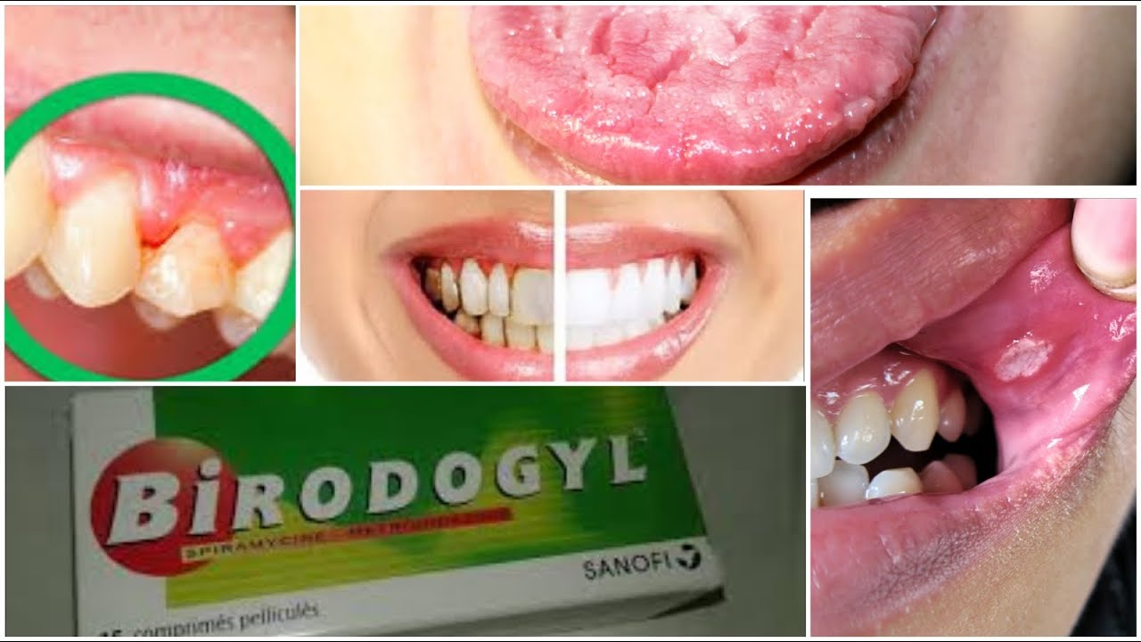 Birodogyl | دواء لعلاج التهابات الفم والاسنان واللثة بالاضافة لرائحة ...