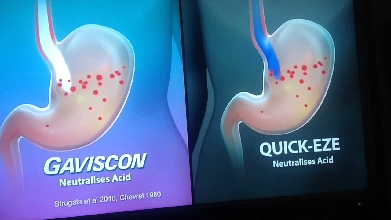 Gaviscon 2017 Ad - YouTube