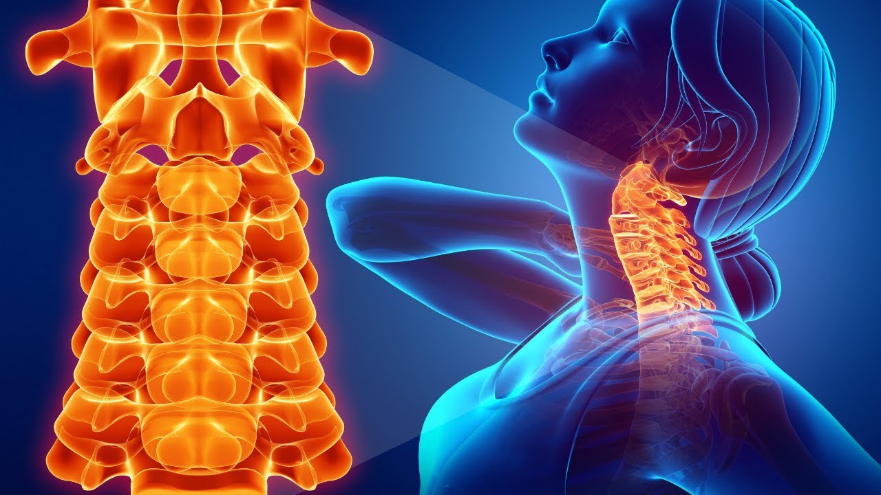 Neck Sprain Symptoms and Proven Treatment - YouTube